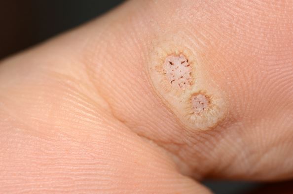What Is a Plantar Wart - Ankle & Foot Centers of America TN